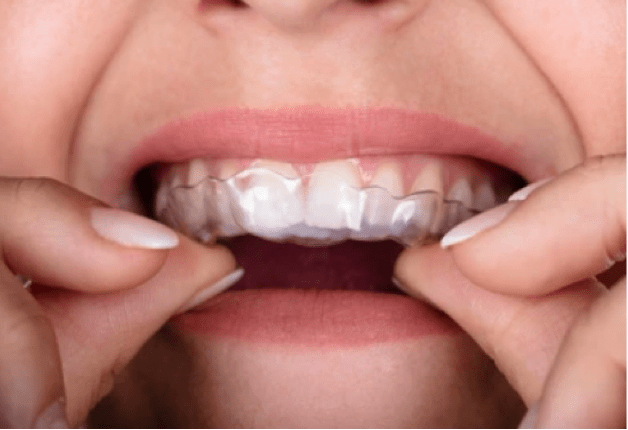 Invisalign Information Morton Grove IL, How Does Invisalign Work