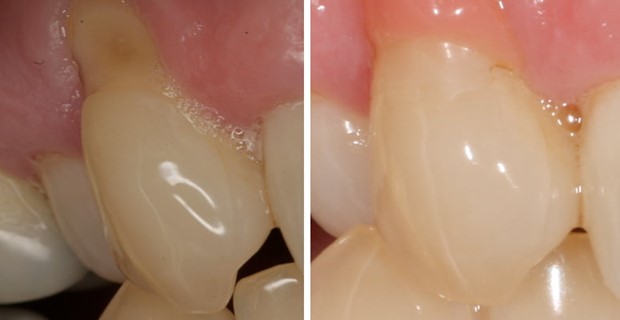 Tooth Wear (Bruxism) Morton Grove IL, ProCare Family Dental