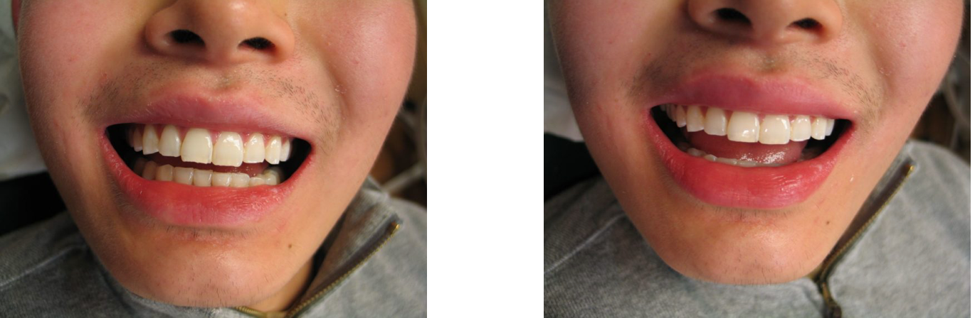 Enameloplasty Morton Grove IL | ProCare Family Dental