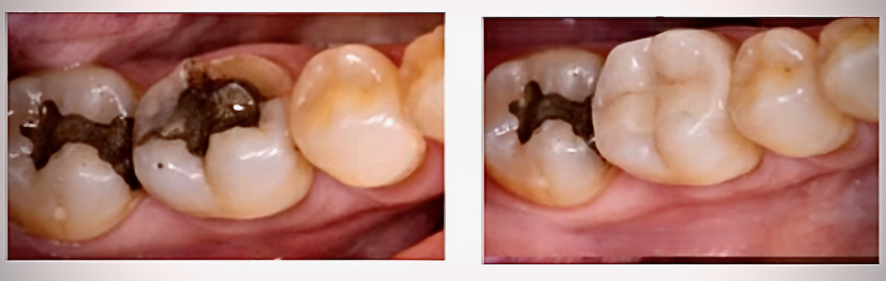 Composite Tooth Fillings Morton Grove | Tooth Colored Dental Fillings