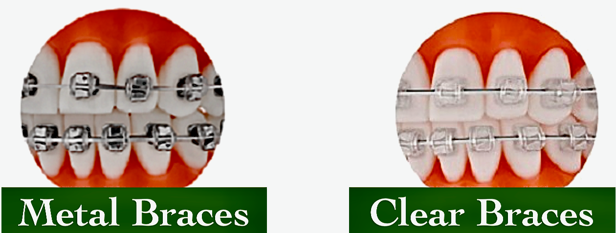 Orthodontic Treatment Morton Grove IL, What Is Orthodontics