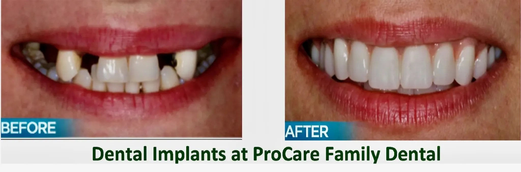 Dental Implants Morton Grove IL, Missing Teeth ProCare Family Dental