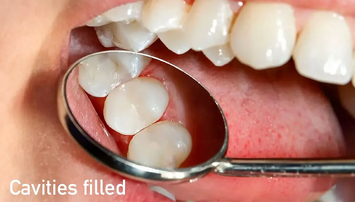 Tooth Decay Treatment in Morton Grove | ProCare Family Dental