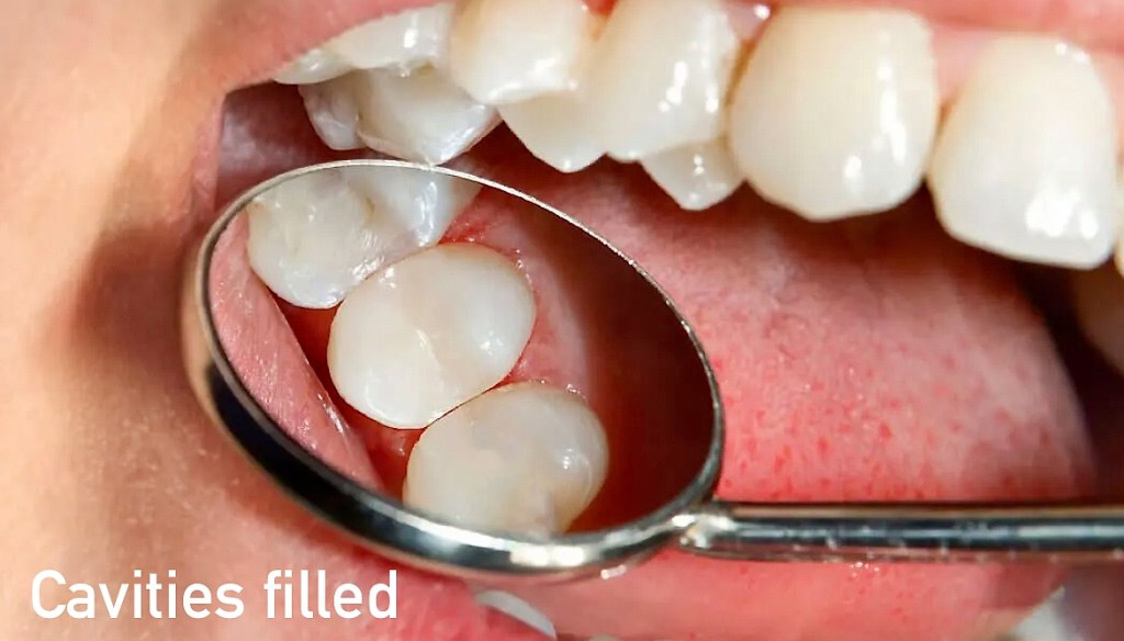 Tooth Decay Treatment in Morton Grove | ProCare Family Dental
