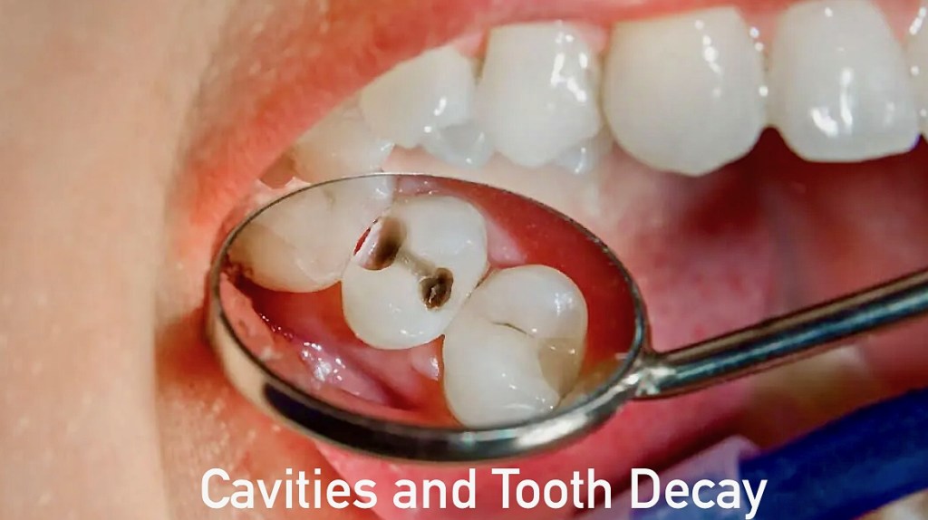 Tooth Decay Treatment in Morton Grove | ProCare Family Dental