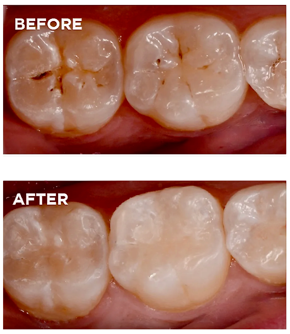 Dental Sealants | ProCare Family Dental – Morton Grove