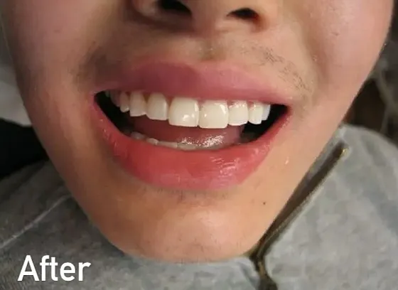 Enameloplasty | ProCare Family Dental – Morton Grove