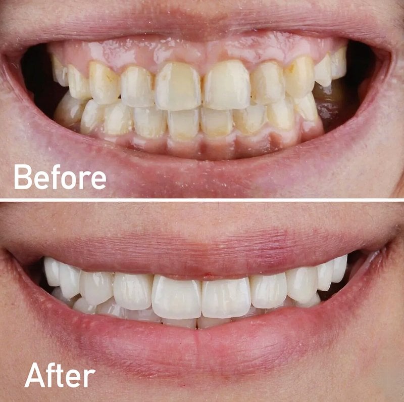 Gummy Smile Treatment Morton Grove | ProCare Family Dental