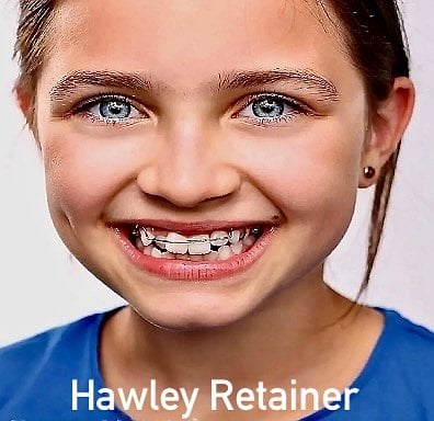 Dental Retainers in Morton Grove | ProCare Family Dental