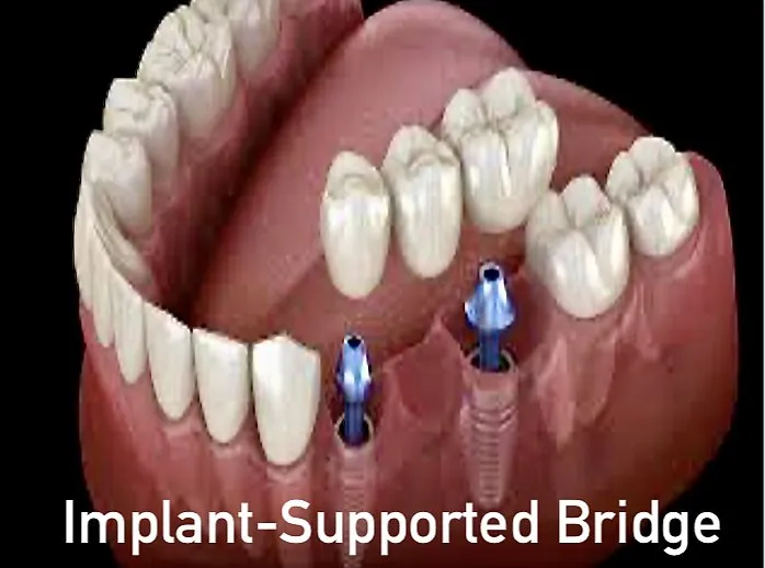 Implant-Supported Dental Bridges Morton Grove ProCare Dental