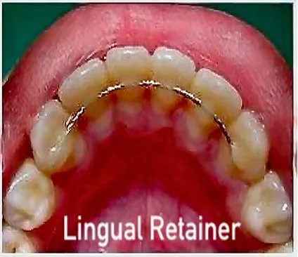 Dental Retainers in Morton Grove | ProCare Family Dental