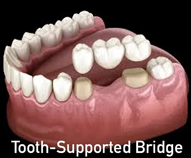 Implant Bridges Morton Grove, IL | ProCare Family Dental