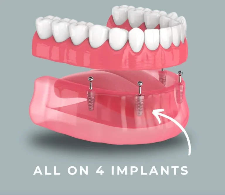 All-on-4 Dental Implants in Morton Grove | ProCare Family Dental