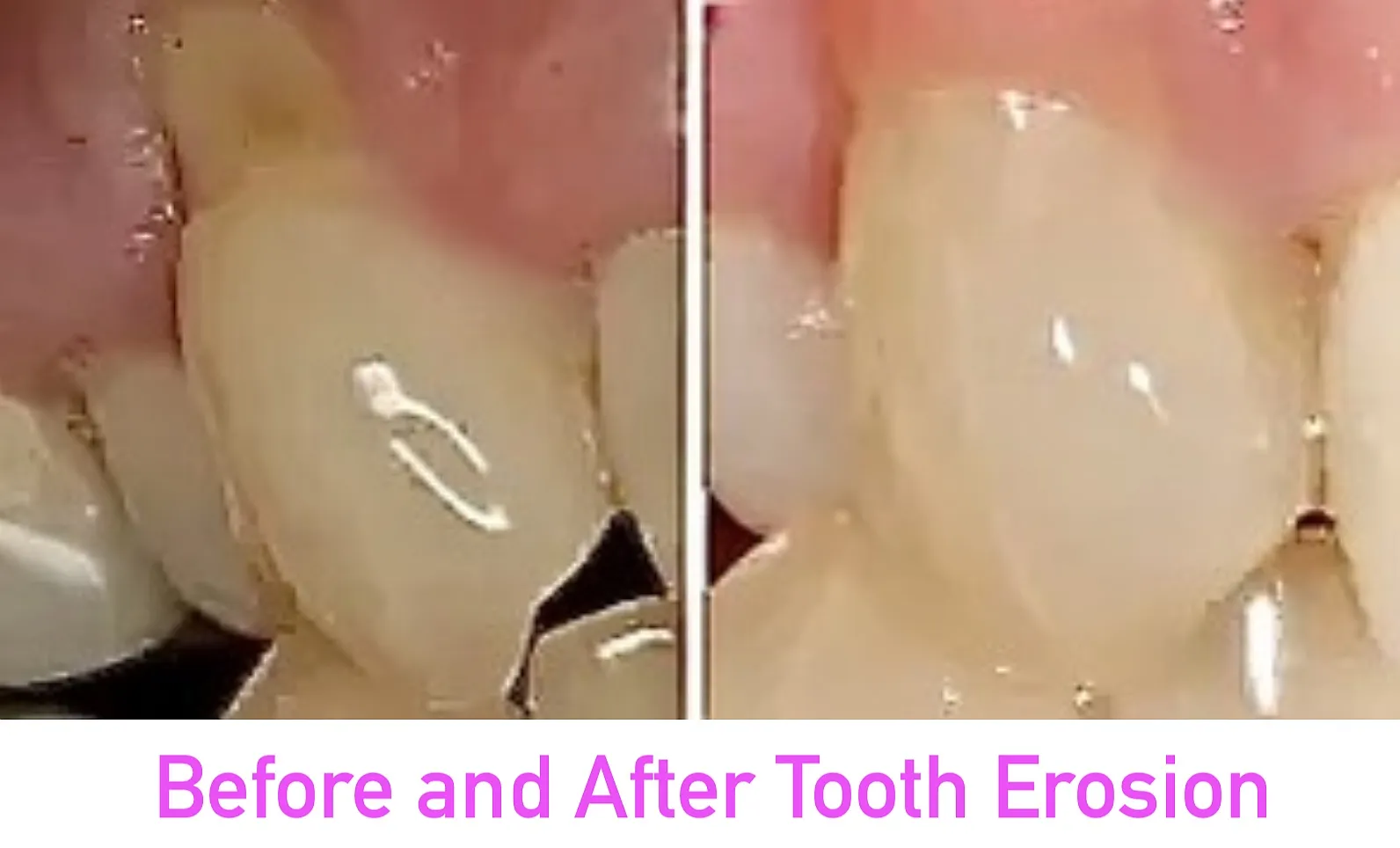 Tooth Wear (Bruxism) | ProCare Family Dental – Morton Grove