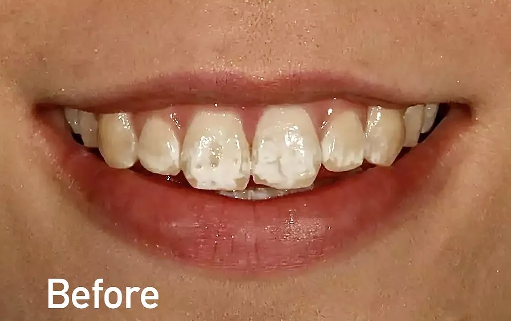 White Spot Removal in Morton Grove, IL | ProCare Family Dental