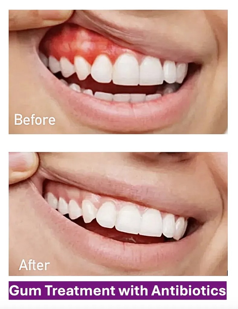 Bleeding Gums | ProCare Family Dental – Morton Grove