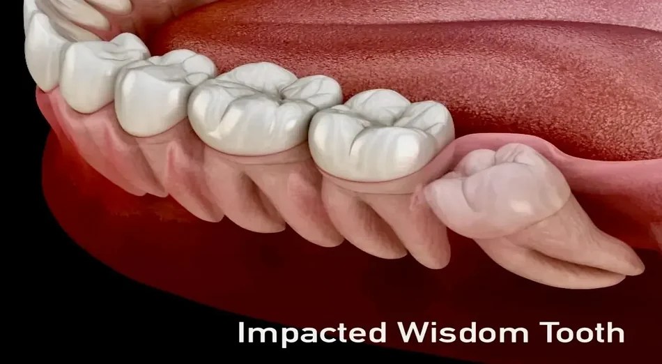 Wisdom Tooth Removal in Morton Grove, IL | ProCare Dental